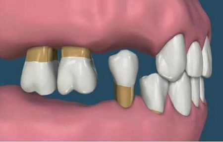 Ausencia de las piezas dentarias - Clínica Dental Dr. Reato