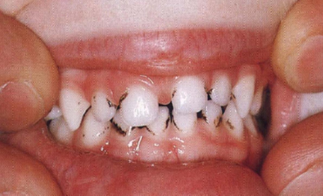 ¿Manchas en los dientes por exceso de hierro? - Maurizio Reato Dentista ...